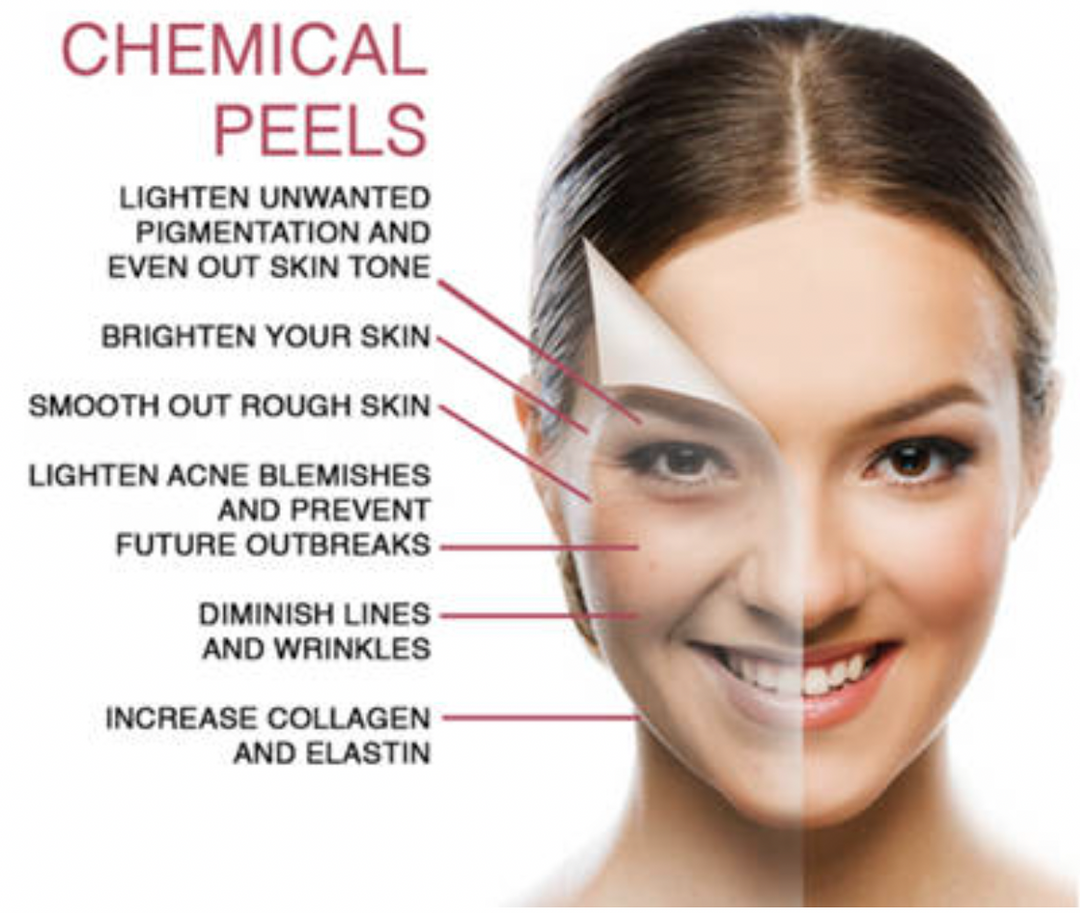 Chemical Peel Acne Scars Imago Aesthetic