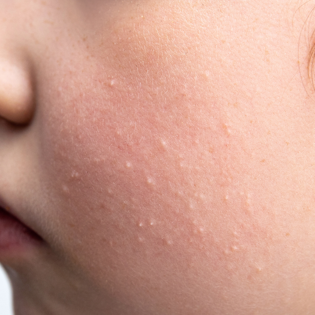 Milia Seeds: Causes & Care - IMAGO Aesthetic