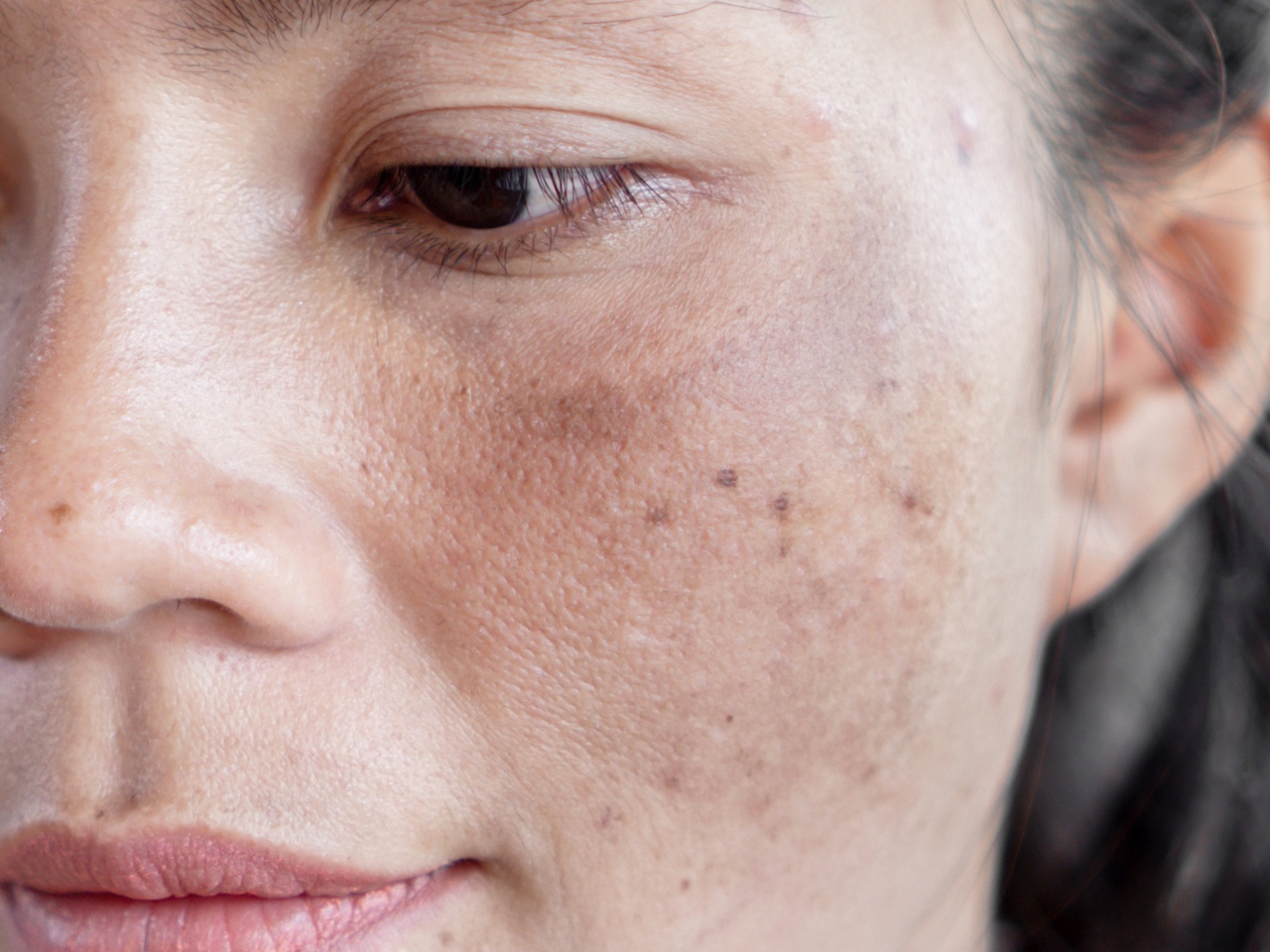 Pigmentation Removal Laser | For Uneven Skin Tone at $99 - IMAGO Aesthetic