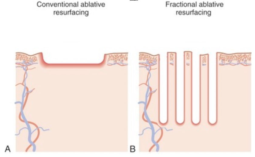 Stretch Marks Removal With Fractional CO2 Laser Review - IMAGO Aesthetic