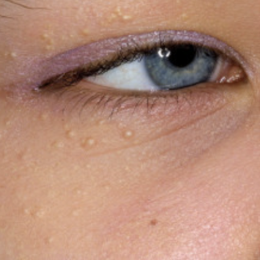 Skin Tags Removal Singapore - IMAGO Aesthetic