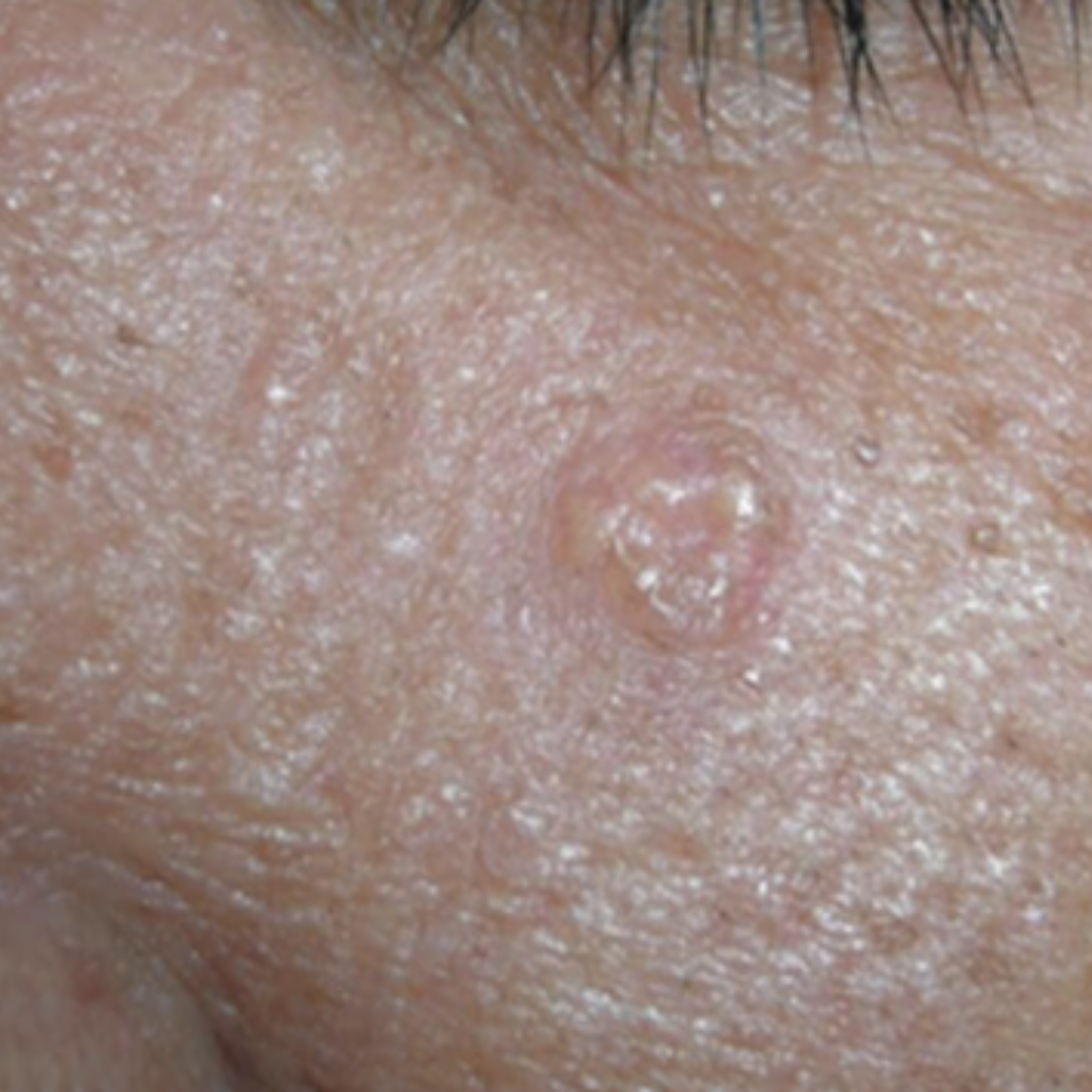Skin Tags Removal Singapore - IMAGO Aesthetic