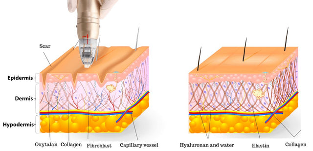 RF Microneedling Guide: Unveil the Secret to Radiant Skin in 2024 ...