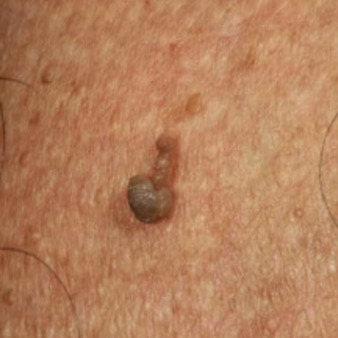 Skin Tags Removal Singapore - IMAGO Aesthetic